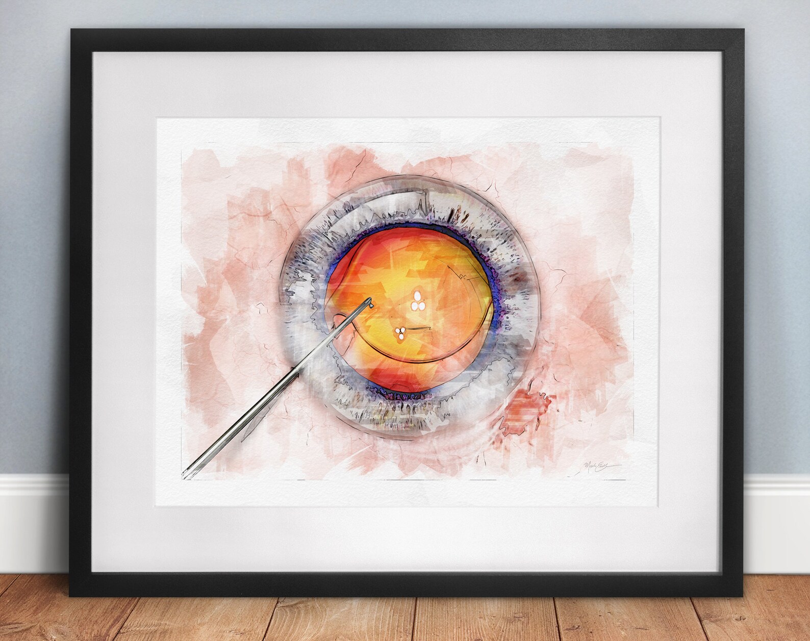 Cataract Doctor Gift Cataract and IOL Lens Positioning - Etsy