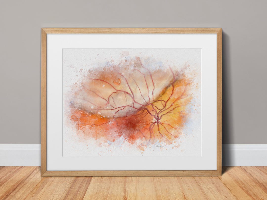 Retinal Tear and Detachment Art Print for Optometrists and ...