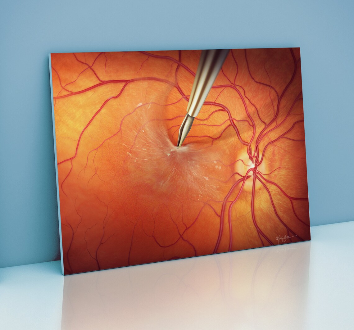 Retina Art Print Epiretinal Membrane Peel Retina Surgeon - Etsy