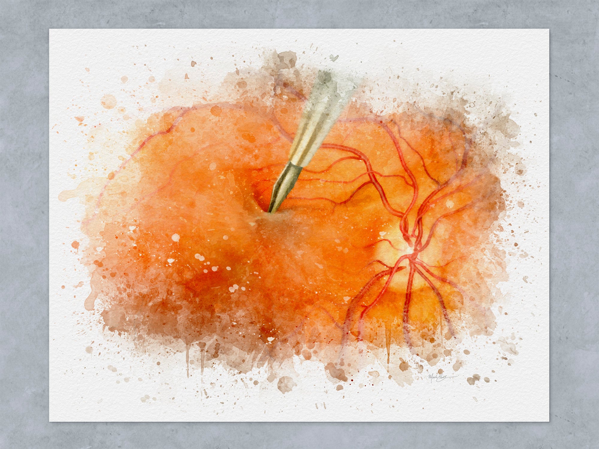 Retina Doctor Gift Retina Art Print Retina Surgery Wall - Etsy