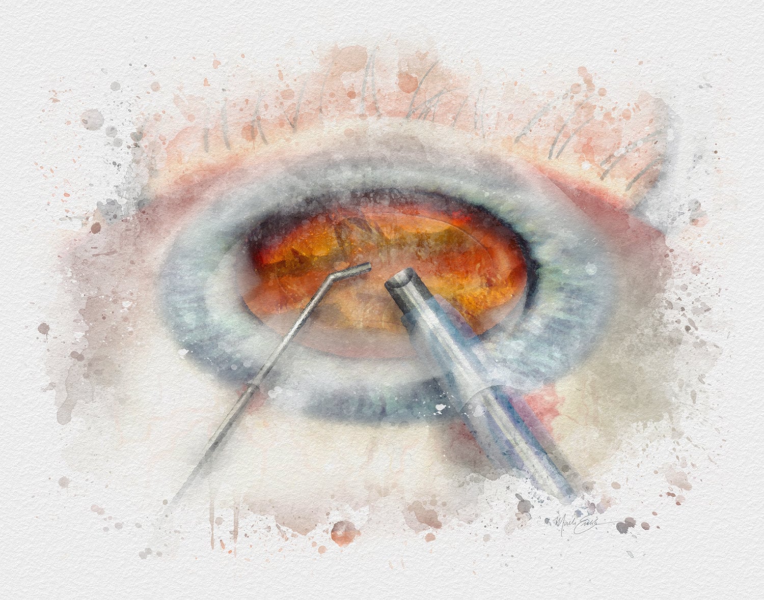 Cataract Surgery Art Print Gift for an Eye Surgeon - Etsy