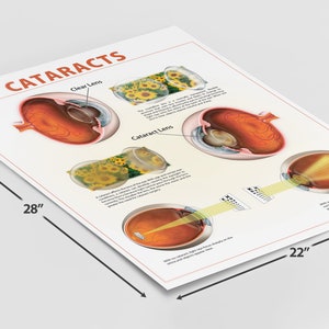 Cataract Poster DIGITAL DOWNLOAD Extra Large. Eye Doctor Exam Room ...