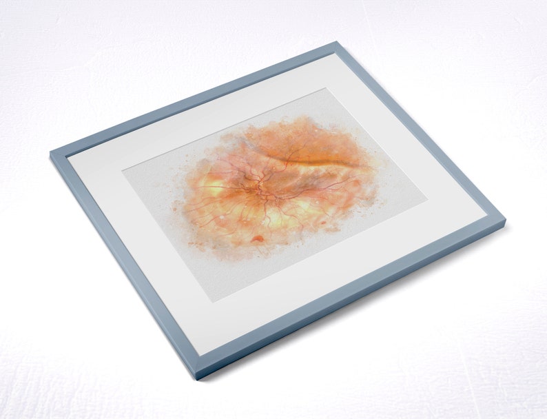 Eye Doctor Gift Retinal Detachment Watercolor-style Painting Retina Art ...