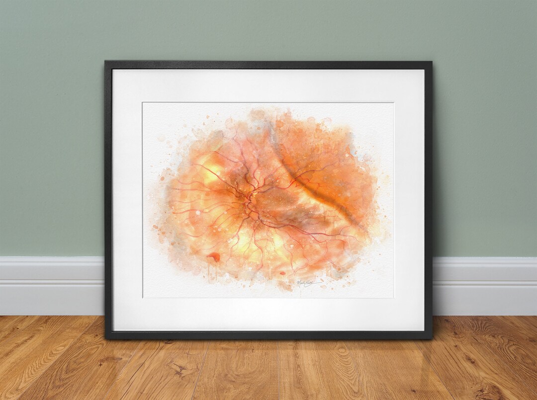 Eye Doctor Gift Retinal Detachment Watercolor-style Painting Retina Art ...