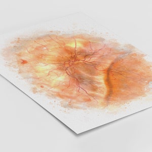 Eye Doctor Gift Retinal Detachment Watercolor-style Painting Retina Art ...