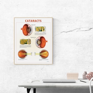 Cataract Poster DIGITAL DOWNLOAD. Eye Doctor Exam Room Instant ...