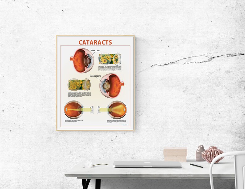 Cataract Poster DIGITAL DOWNLOAD. Eye Doctor Exam Room Instant ...