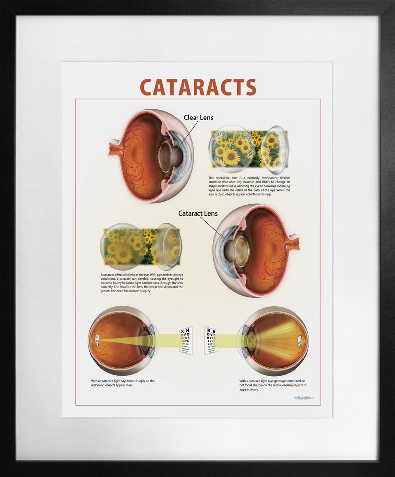 Cataract Poster DIGITAL DOWNLOAD. Eye Doctor Exam Room Instant ...