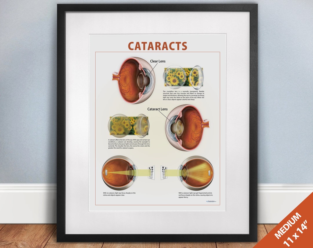 Cataract Poster DIGITAL DOWNLOAD. Eye Doctor Exam Room Instant ...