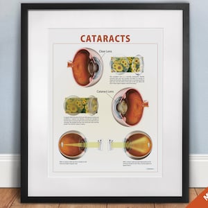 Cataract Poster DIGITAL DOWNLOAD. Eye Doctor Exam Room Instant ...