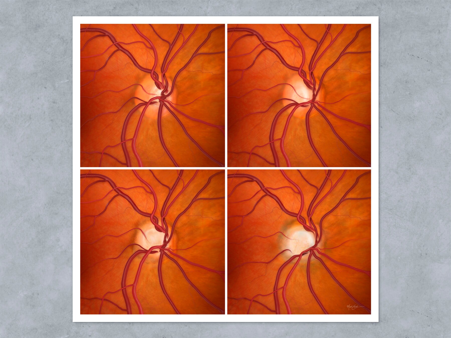 Optic Nerve Cupping Progression Illustration Art Print - Etsy