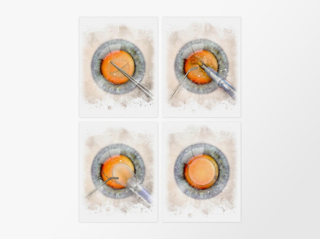 Cataract Surgery Art Set – Watercolor Style Eye Surgical Prints for ...
