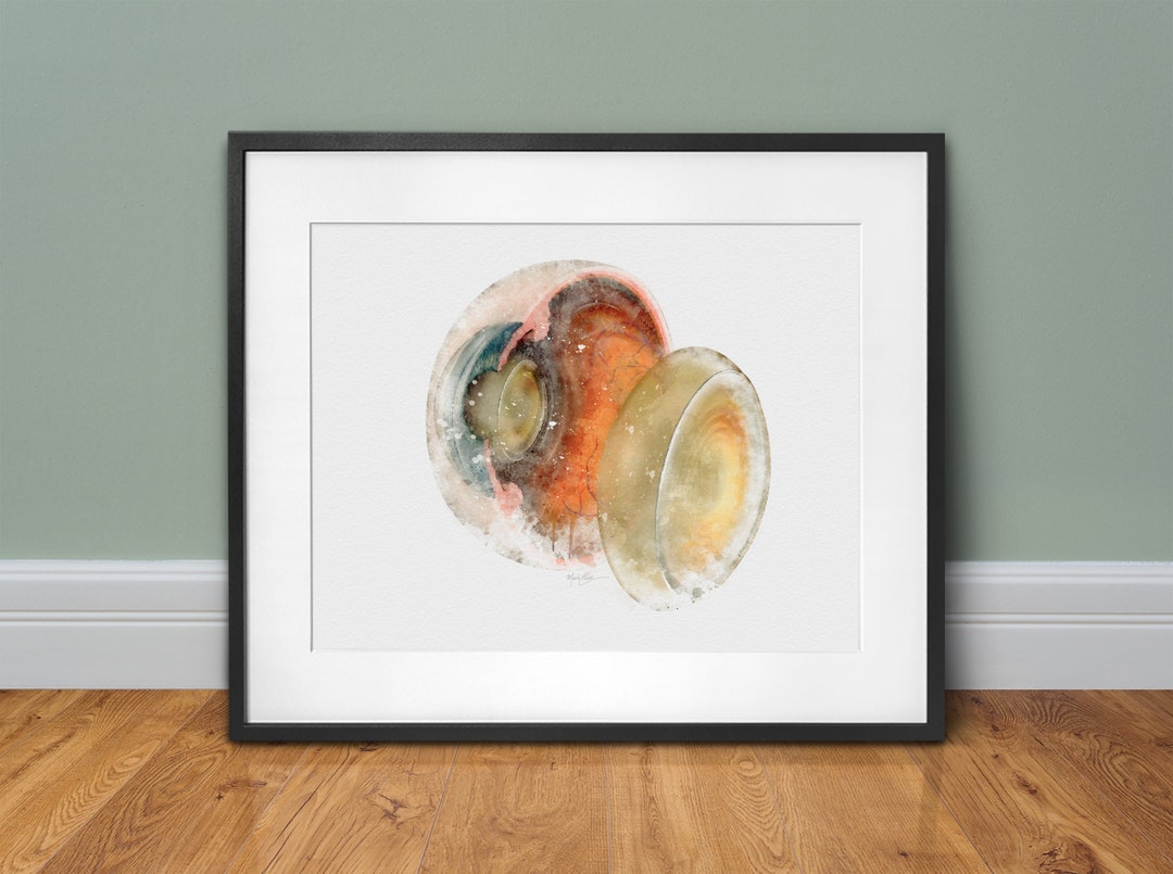 Cataract Art Print, Eye Doctor Graduation Gift, Cataract Watercolor ...