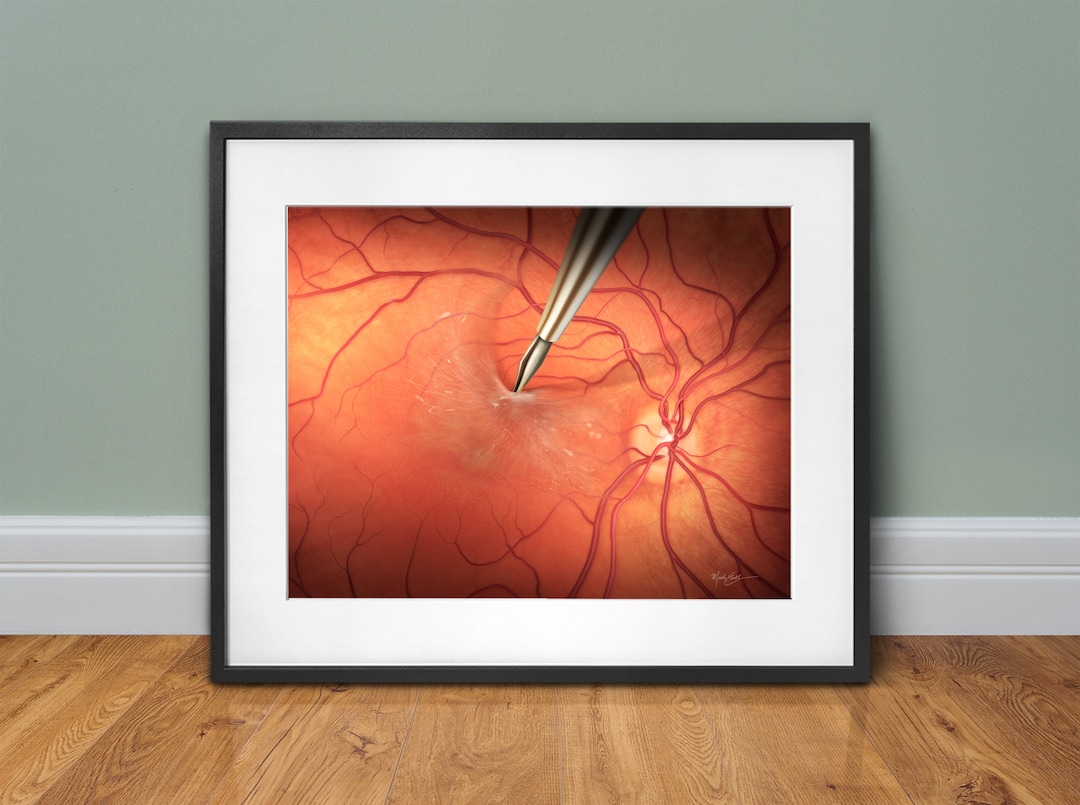 Retina Art Print, Epiretinal Membrane Peel, Retina Surgeon Gift ...