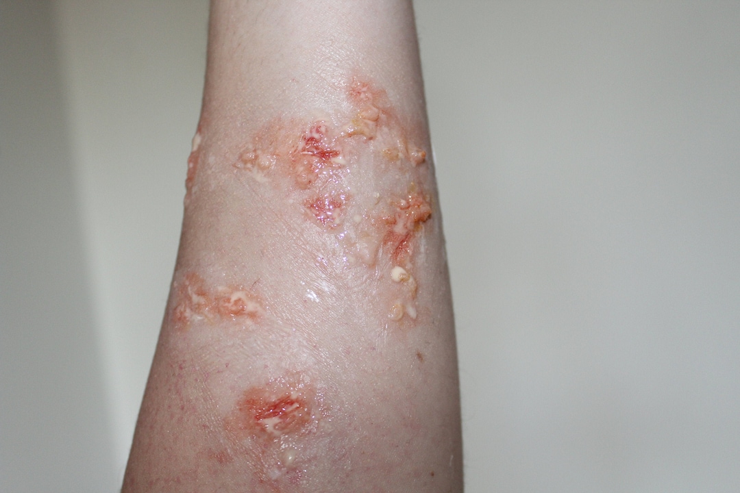 Silicone Prosthetic - Infected Blisters Boils With Synthetic Burn Pus ...