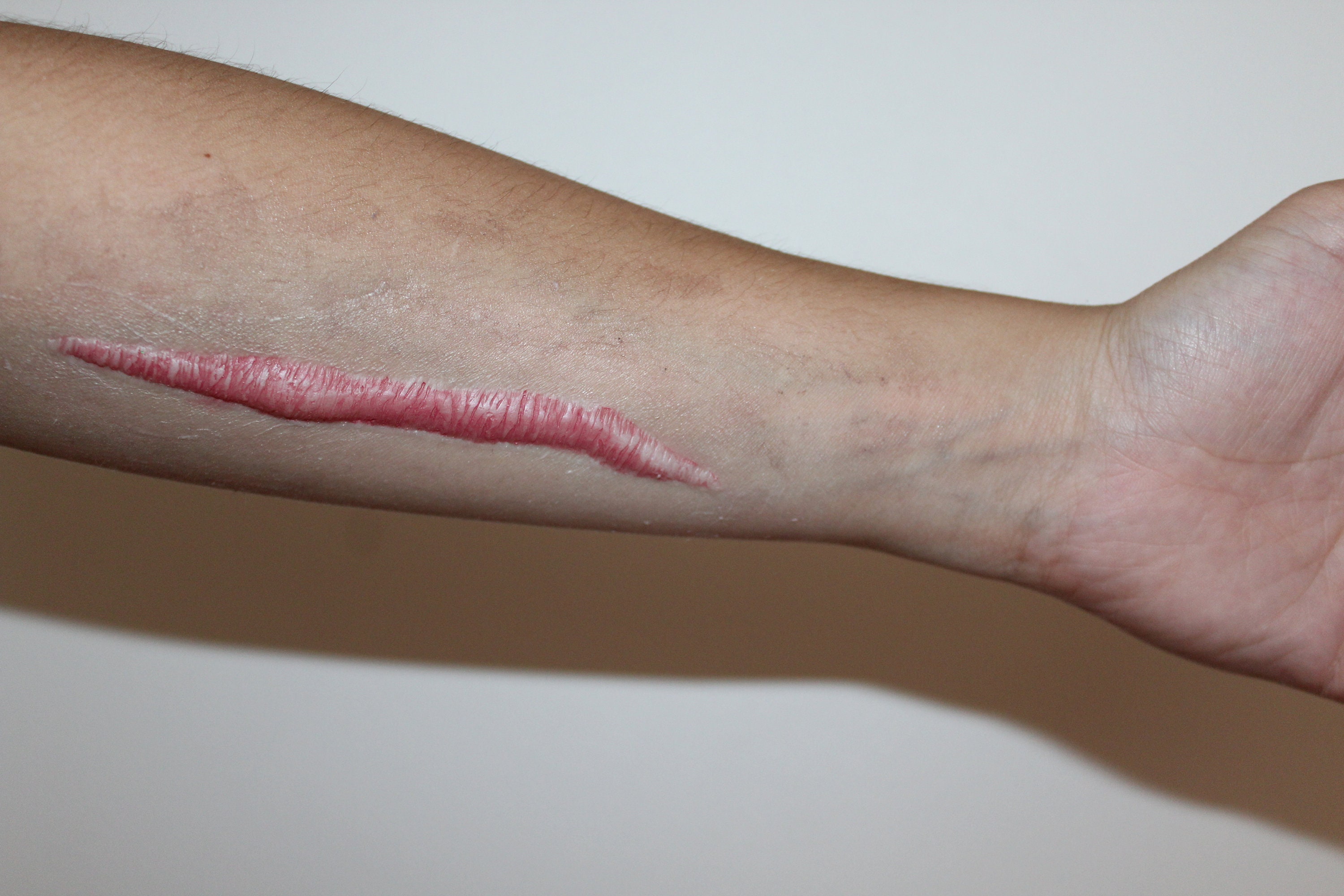Hyper Realistic Thick Raised Keloid Scar Silicone Prosthetic - Etsy UK