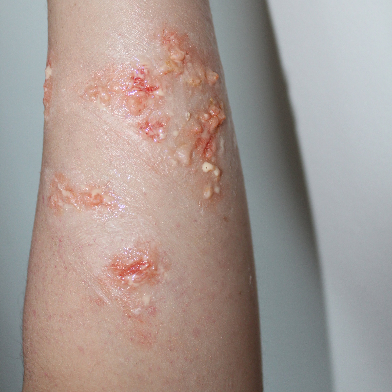Infected Blisters / Boils Prosthetic With Synthetic Burn / Pus - Etsy ...