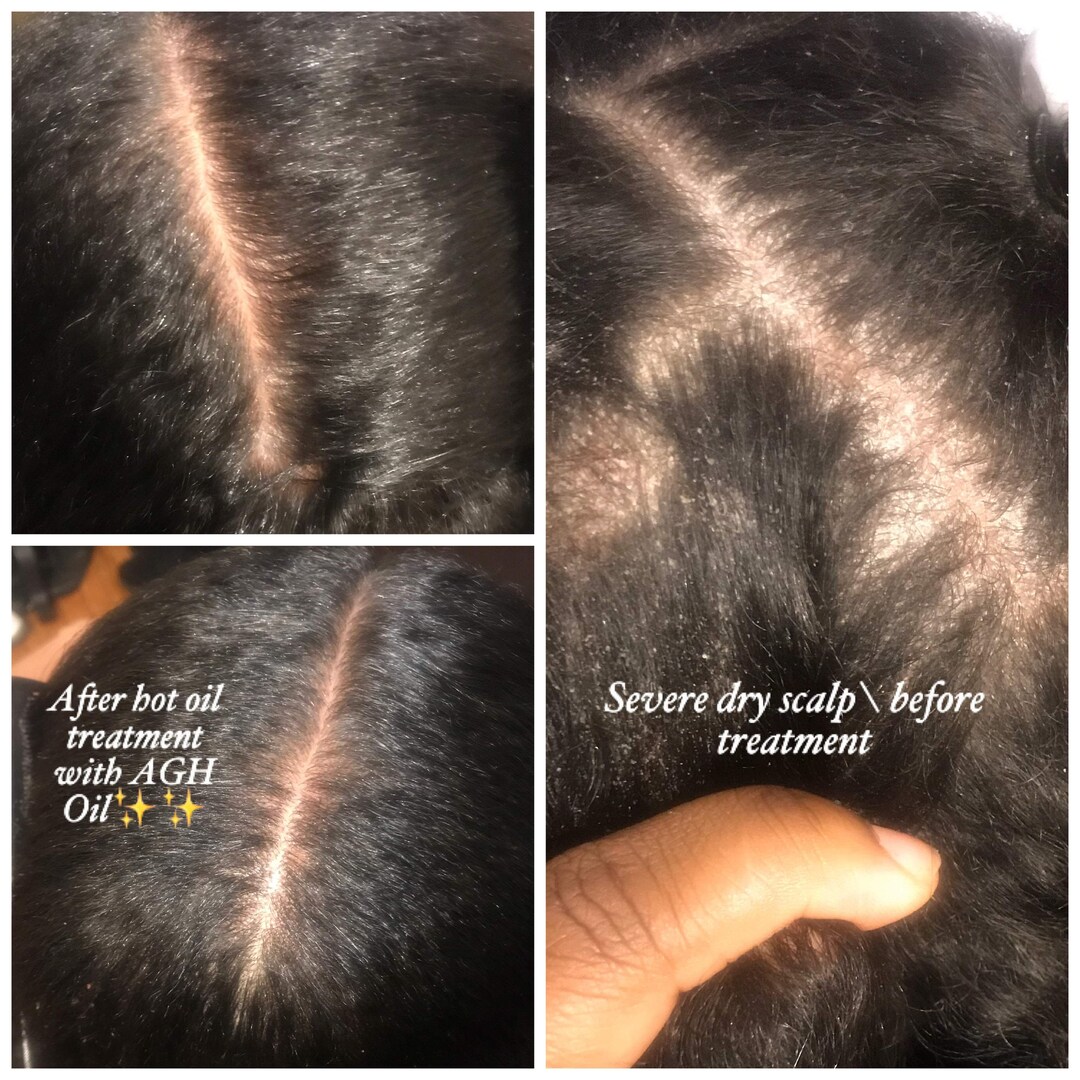 Dandruff Vs Seborrheic Dermatitis