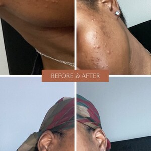 Authentic Somali Qasil East African Face Mask-pore Refining Fades Dark ...