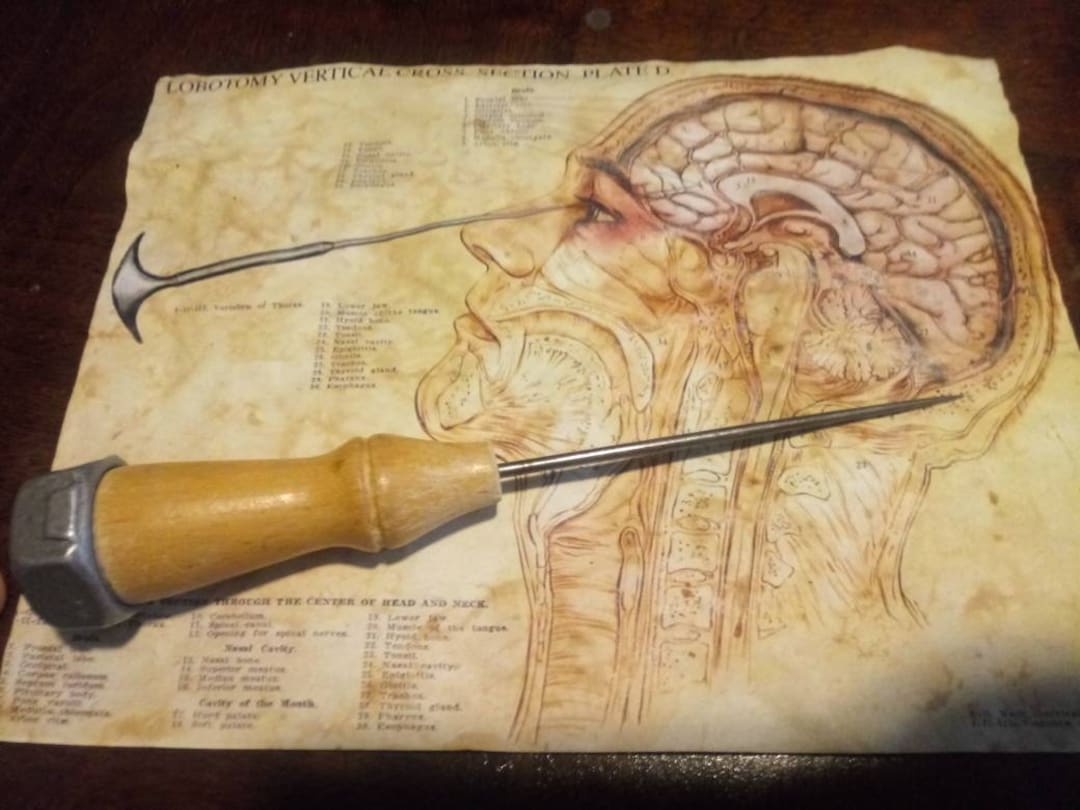 Lobotomy Diagram