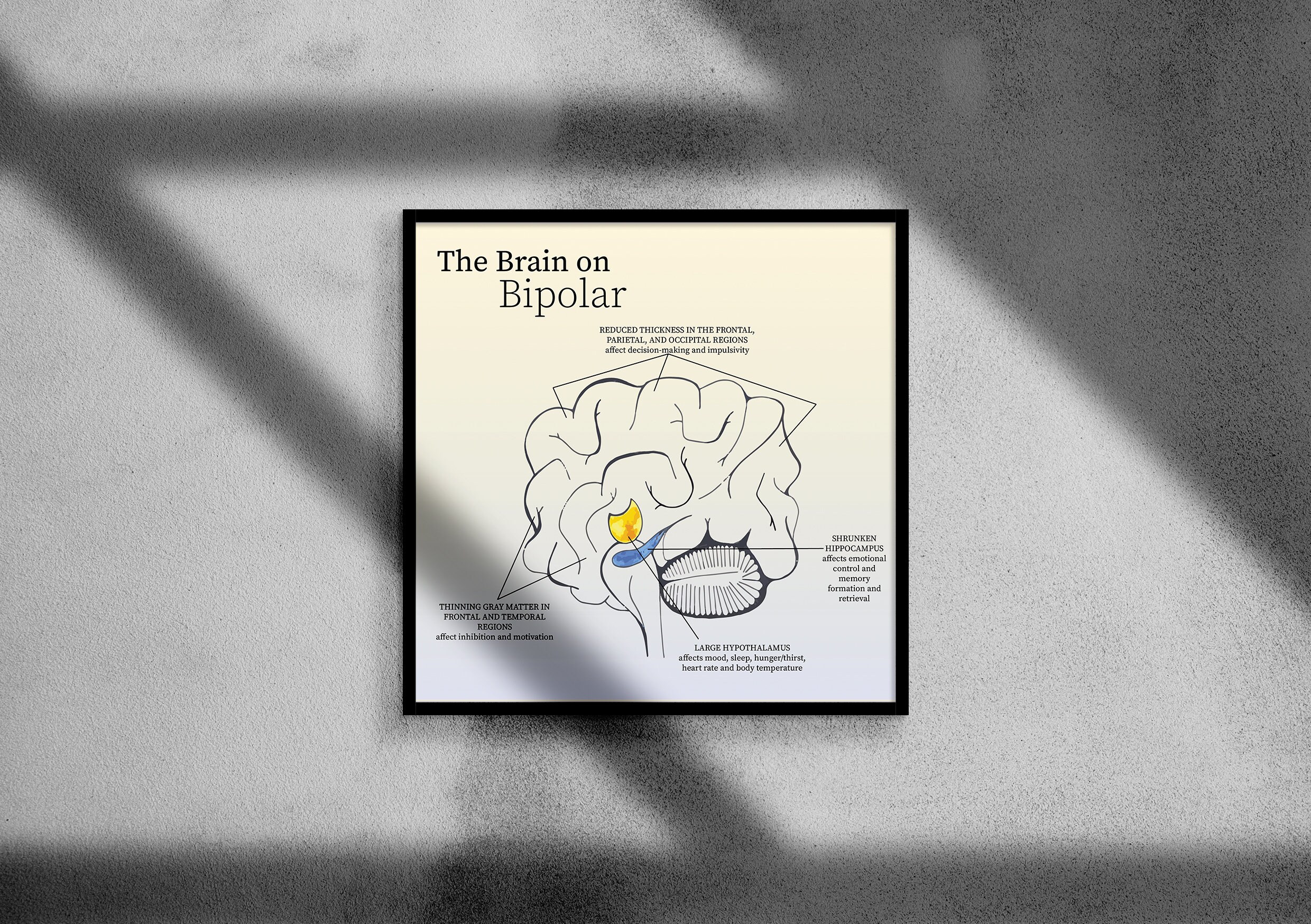 Bipolar Brain Diagram, Brain Digital Printable, Medical Science Art ...