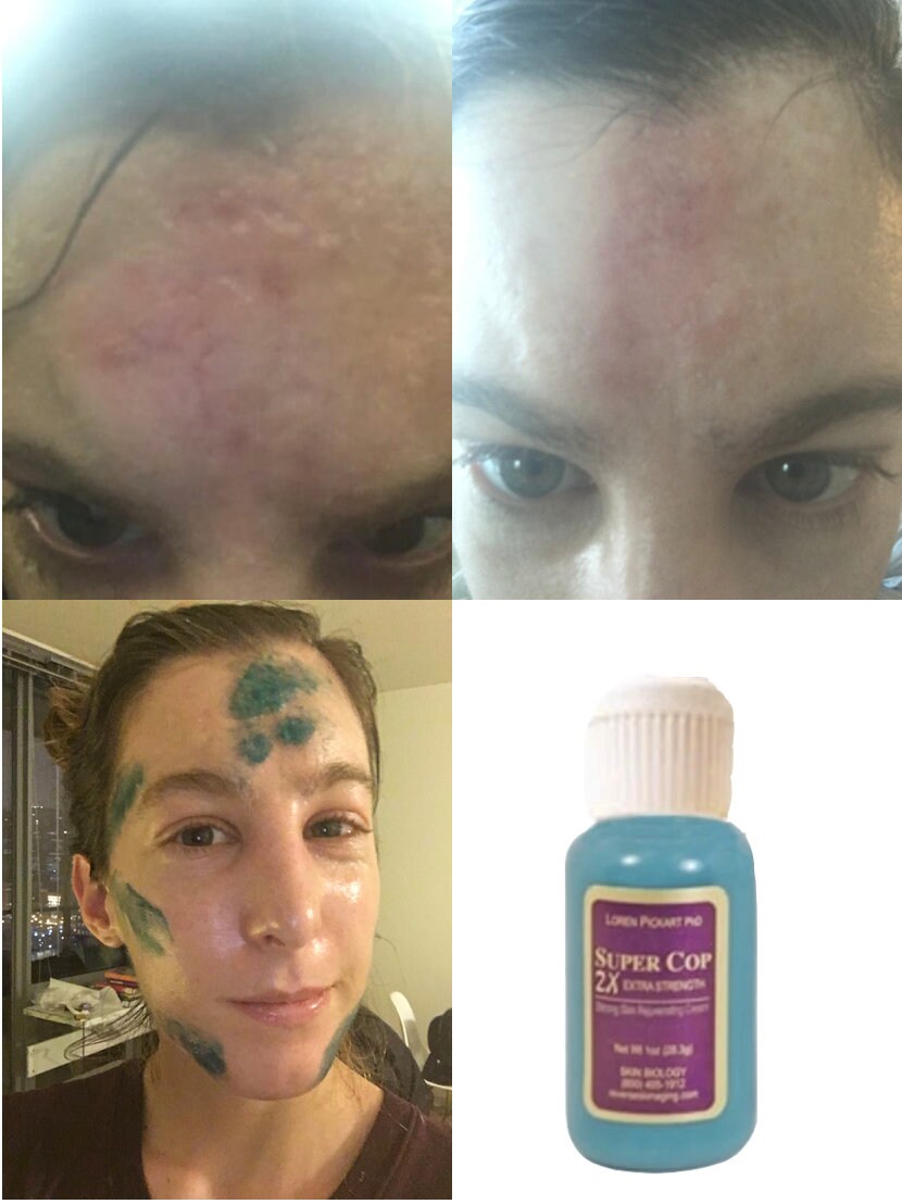 Acne Littekens Ingesprongen Atrofische Rollen Ontpit Diep Heal Remove acne-littekens-ingesprongen-atrofische-rollen-ontpit-diep-heal-remove