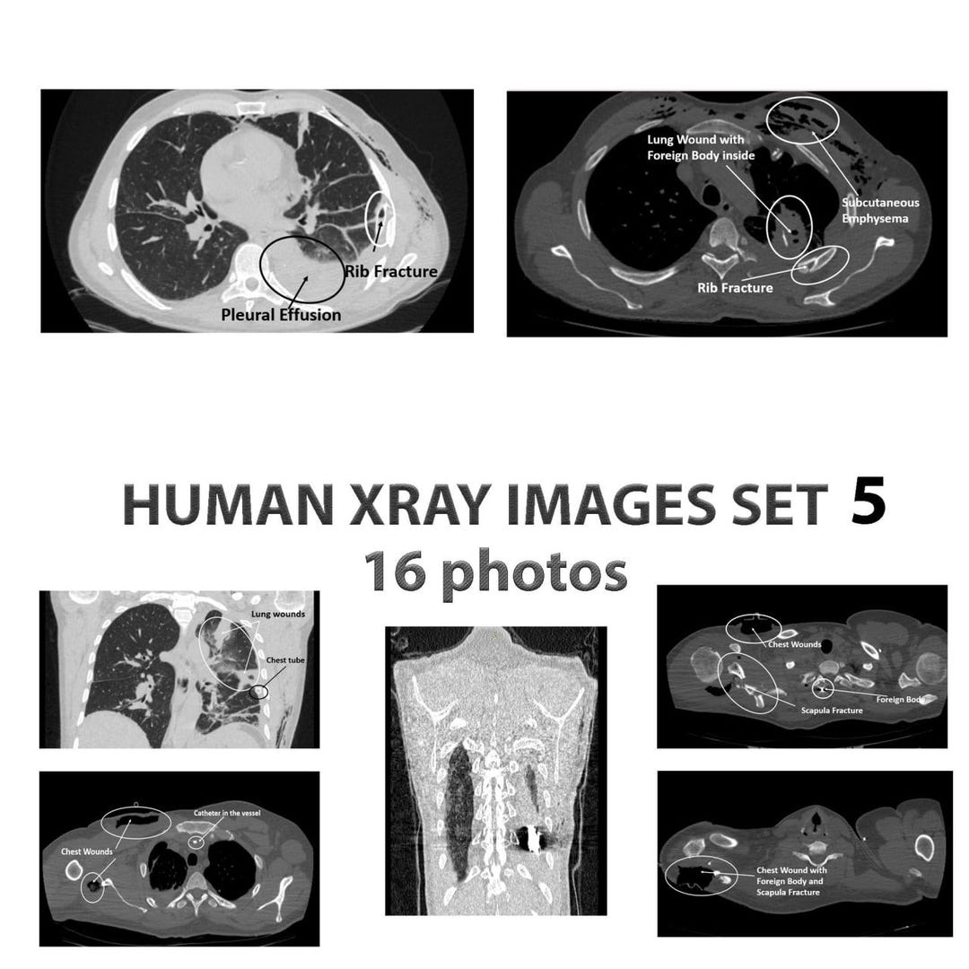 X-ray Images, Posters Xray Printable, Vintage Combat Trauma! X Ray ...