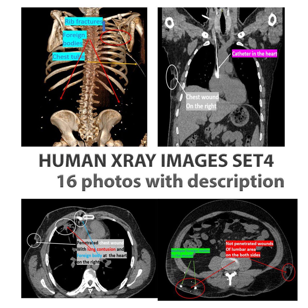 X-ray Images, Posters Xray Printable, Vintage Combat Trauma! X Ray ...