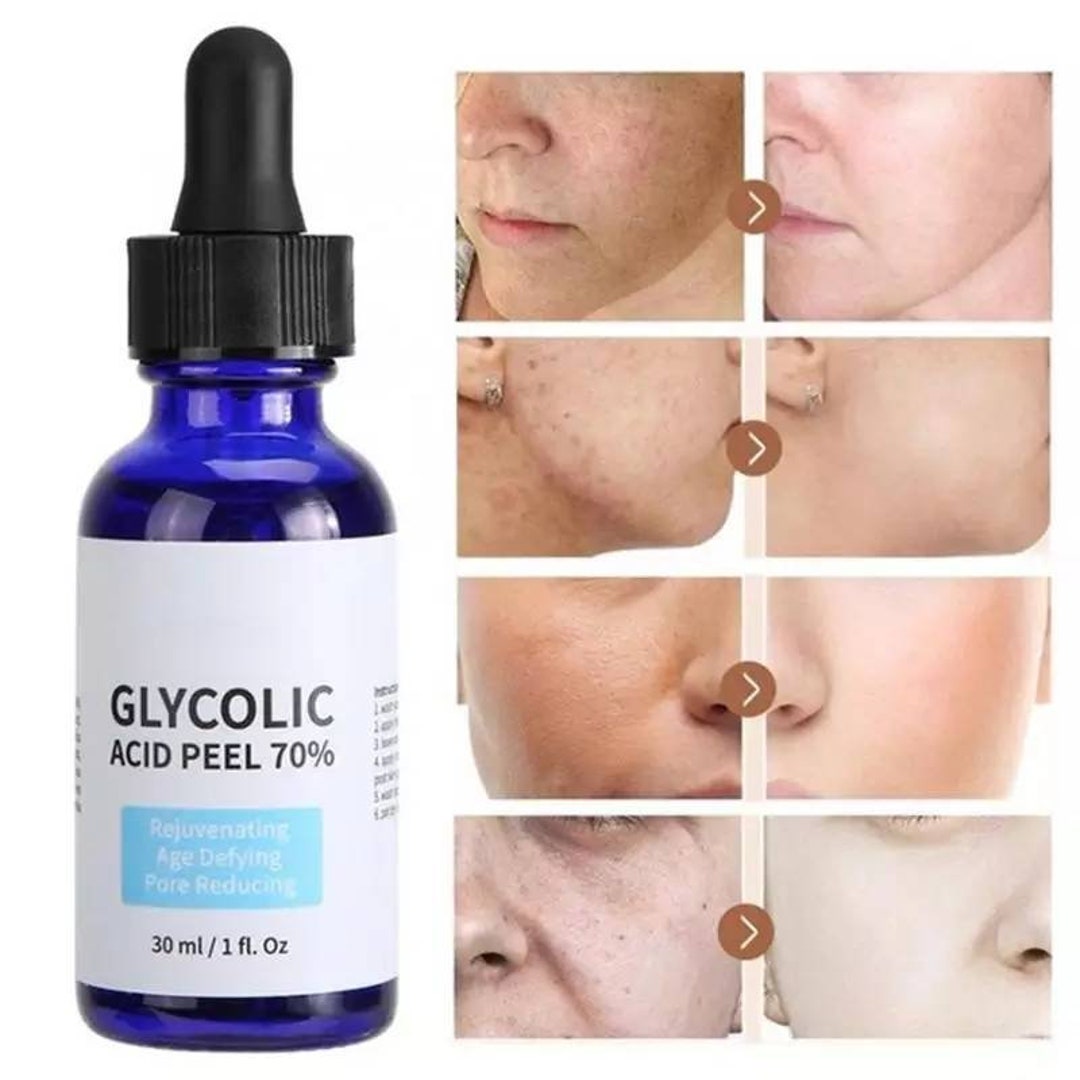 Glycolic Acid Peel, 10, 20, 35, 50, 70 Percent & Gylcolic Toning ...
