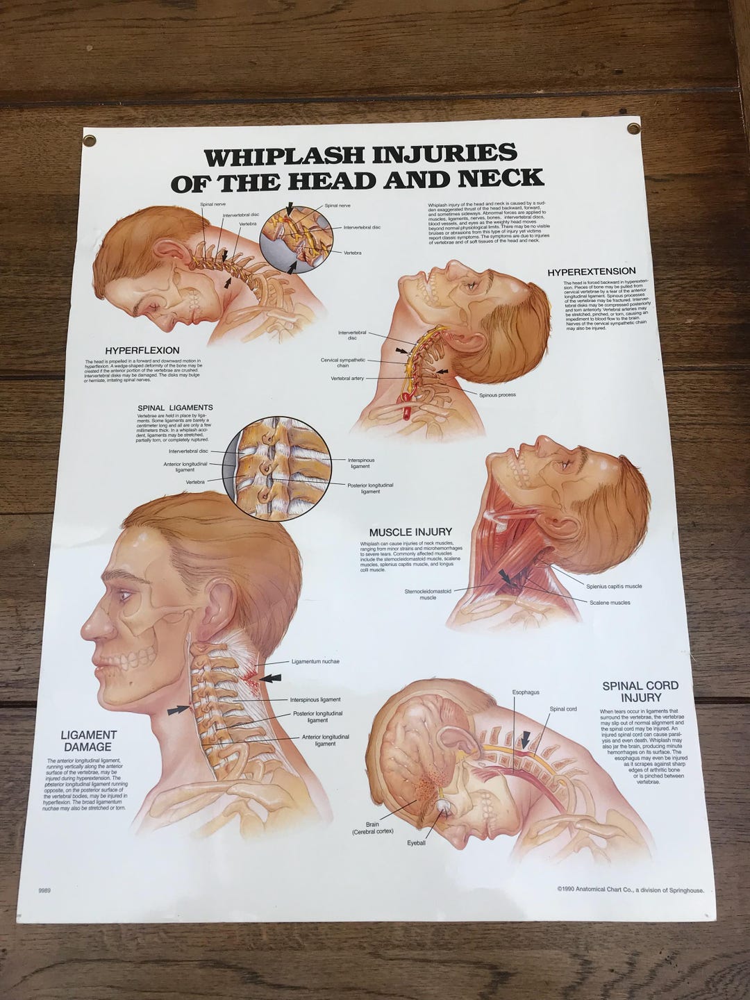 1990 Anatomical Chart Co Laminated Poster of Whiplash Injuries of the ...