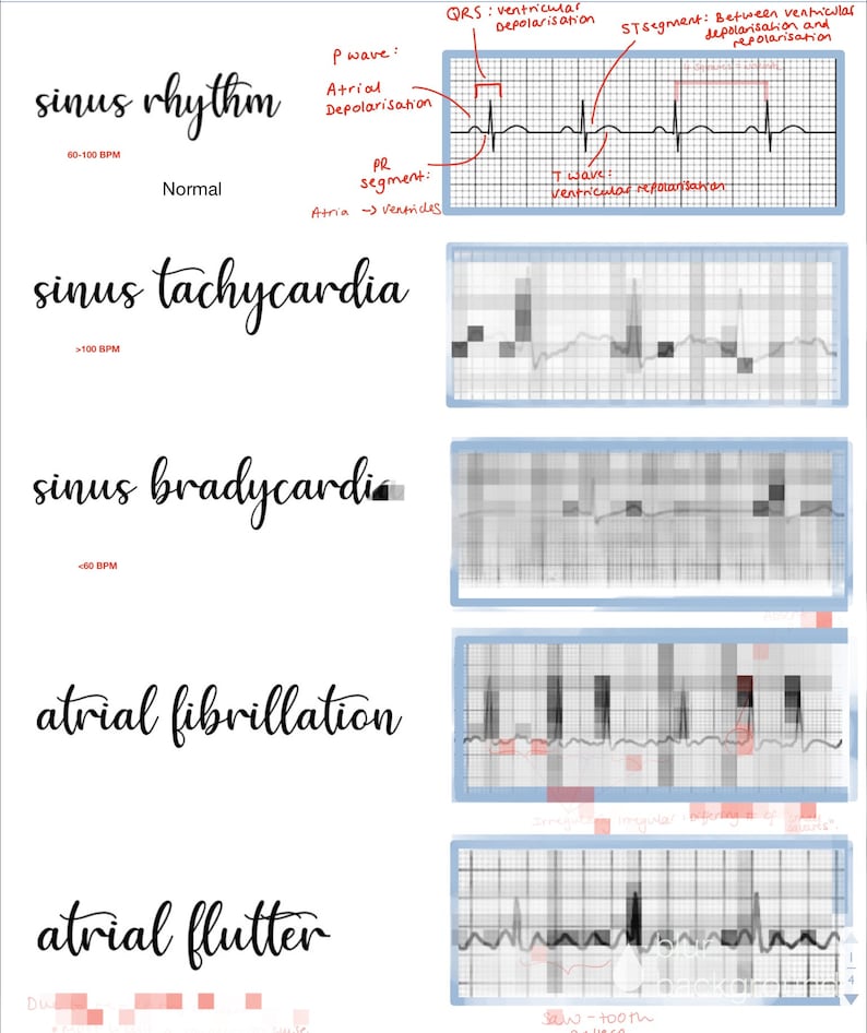 ECG/EKG Cheat Sheet for Medical students/nurses/PAs/paramedics | Etsy