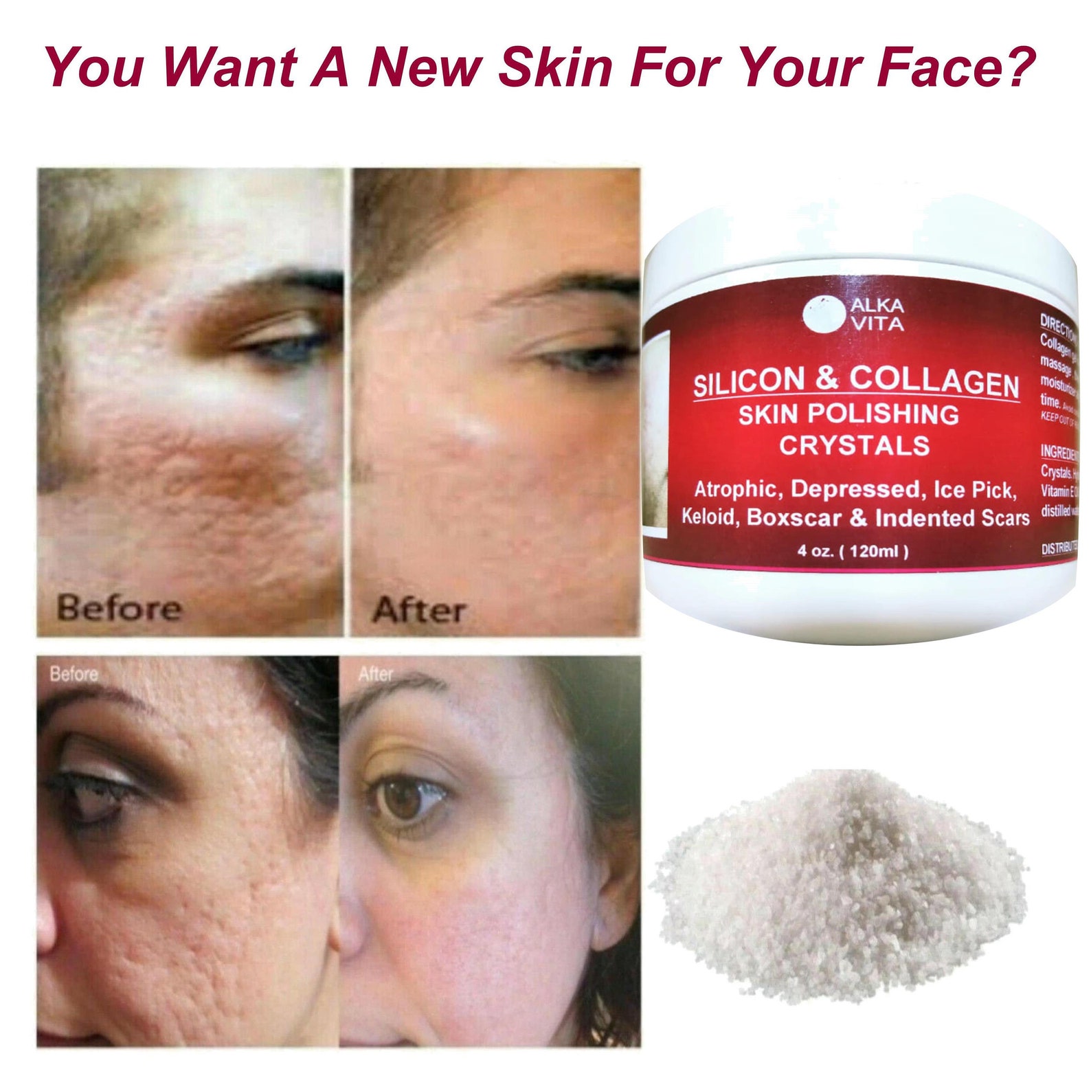 Acne Scars Silicon & Collagen Skin Polishing Crystals Gel for - Etsy UK