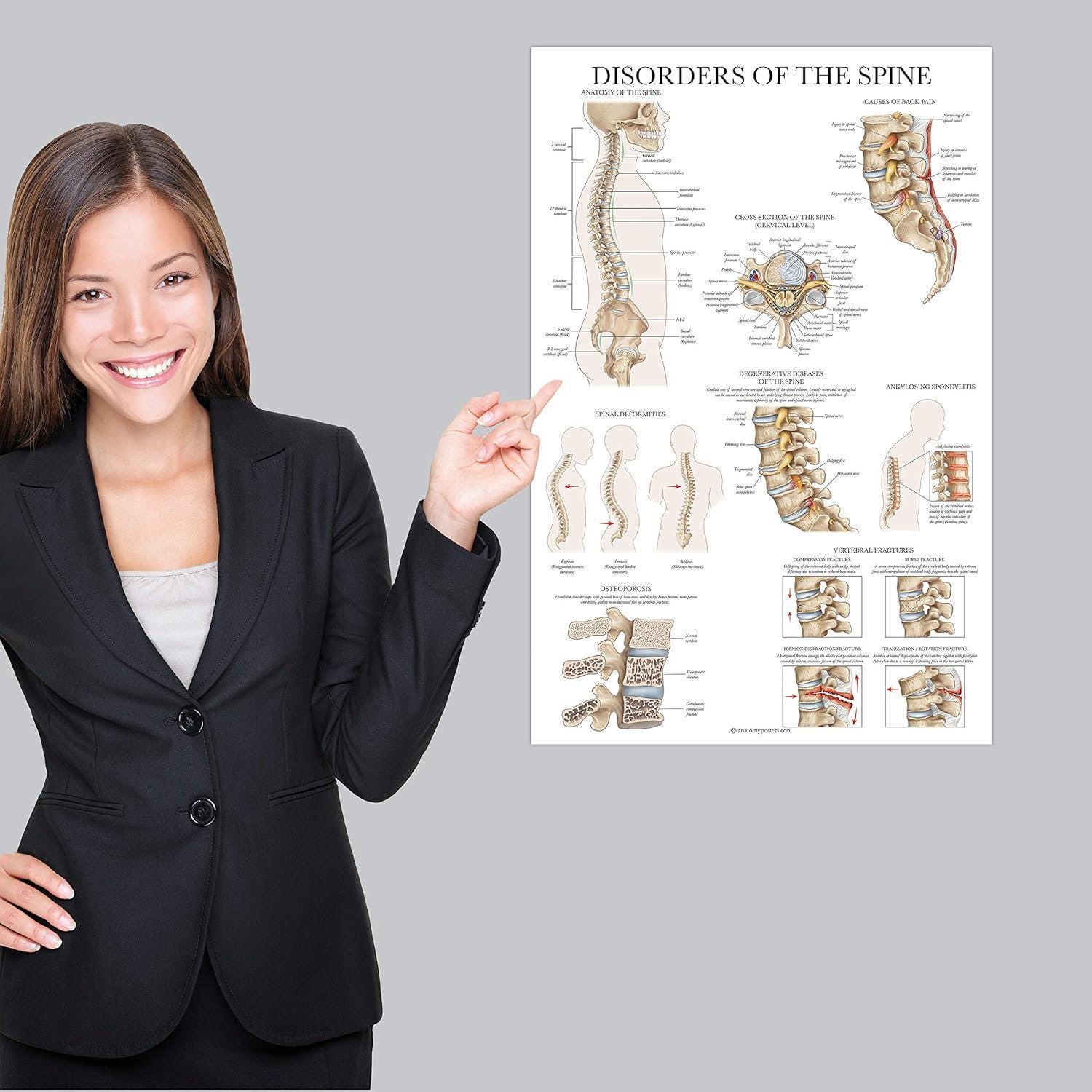 Disorders of the Spine Anatomy Poster - Laminated Spinal Disorders ...