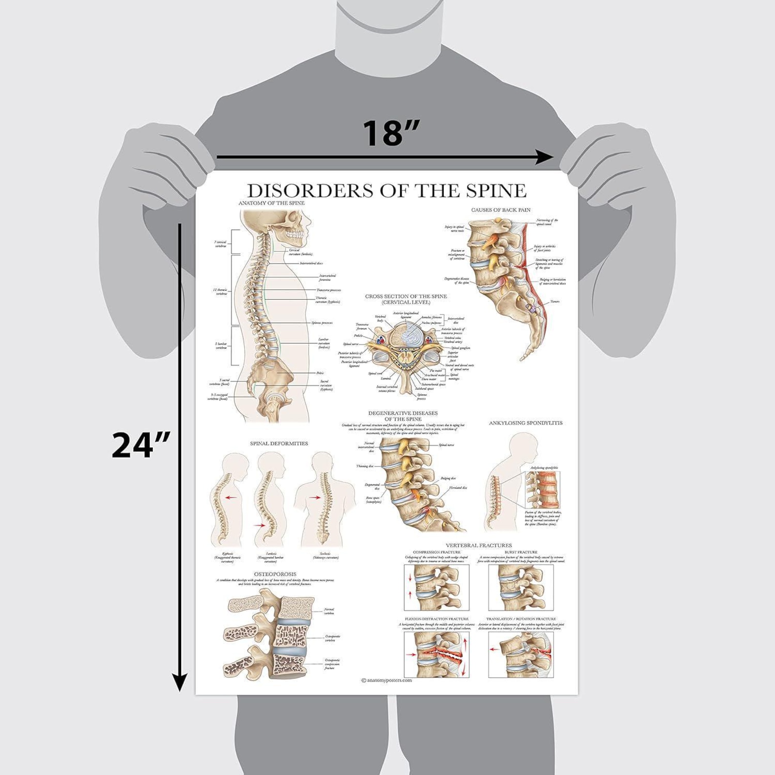 Disorders of the Spine Anatomy Poster - Laminated Spinal Disorders ...