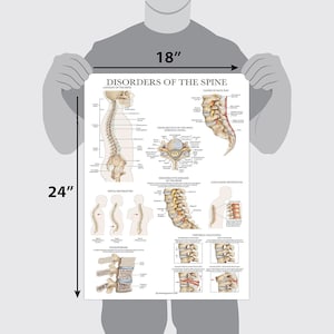 Disorders of the Spine Anatomy Poster - Laminated Spinal Disorders ...