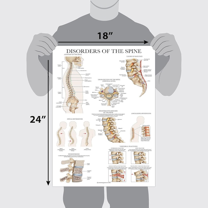 Disorders of the Spine Anatomy Poster - Laminated Spinal Disorders ...