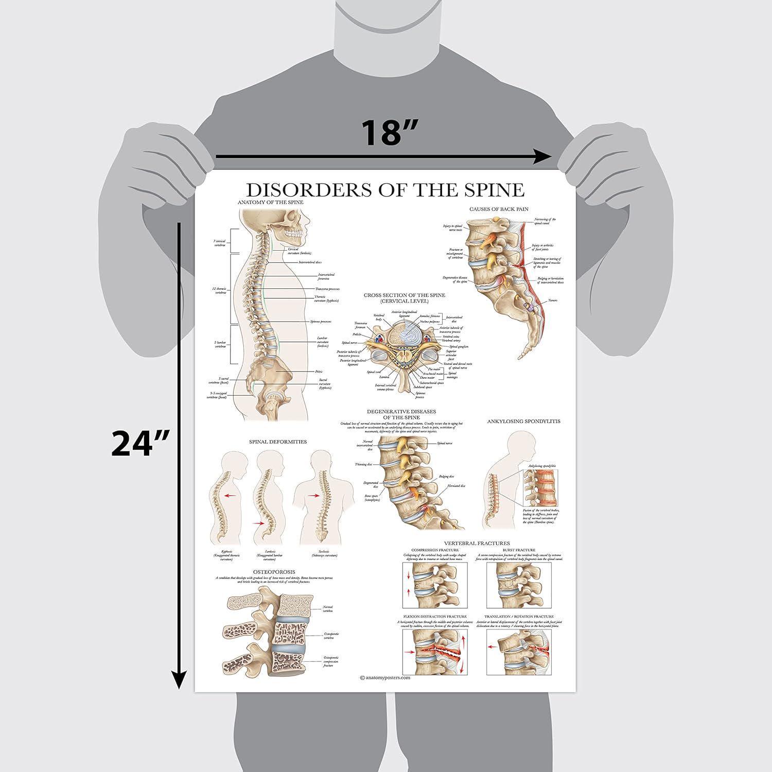 Disorders of the Spine Anatomy Poster - Laminated Spinal Disorders ...