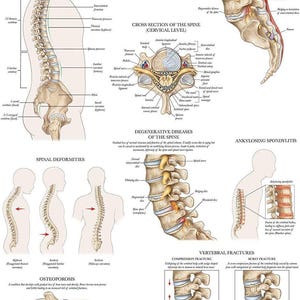 Disorders of the Spine Anatomy Poster - Laminated Spinal Disorders ...