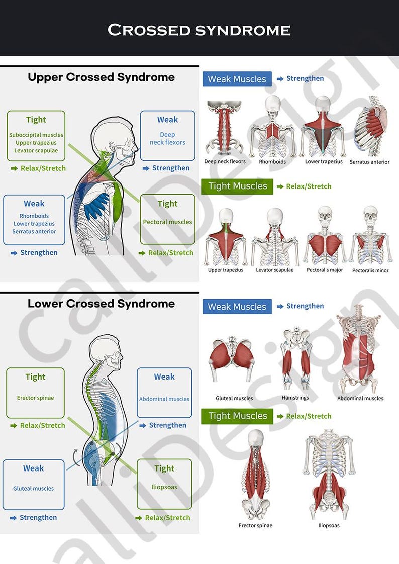 Crossed Syndrome Anatomy Poster: Physical Therapy, Gym Art (A4 Digital ...