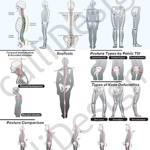 Spine & Posture Chart: Anatomy Poster for Chiropractic, Physical ...