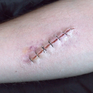 Stitched Wound Prosthetic, Stitches, Gore, SFX Makeup, Silicone ...