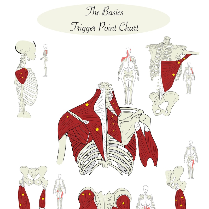Muscle Trigger Point Chart - Etsy