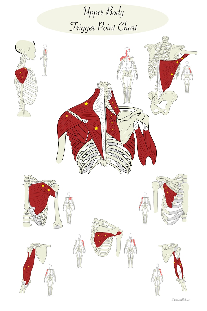 Upper Body - Trigger Point Chart - Muscle Anatomy Art - Chiropractic ...