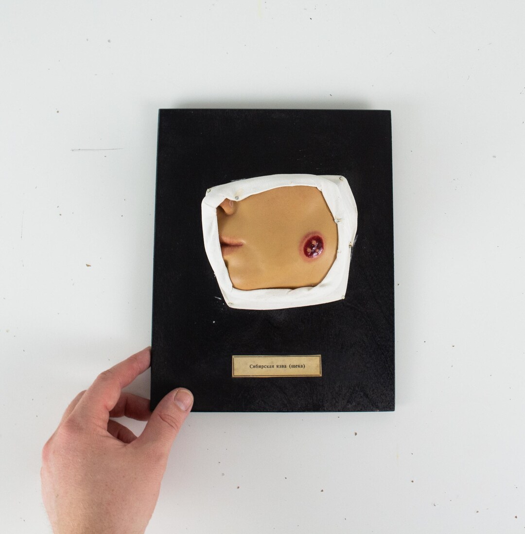 Vintage Wax Anatomical Human Face Model: Skin Anatomy - Siberian Ulcer ...