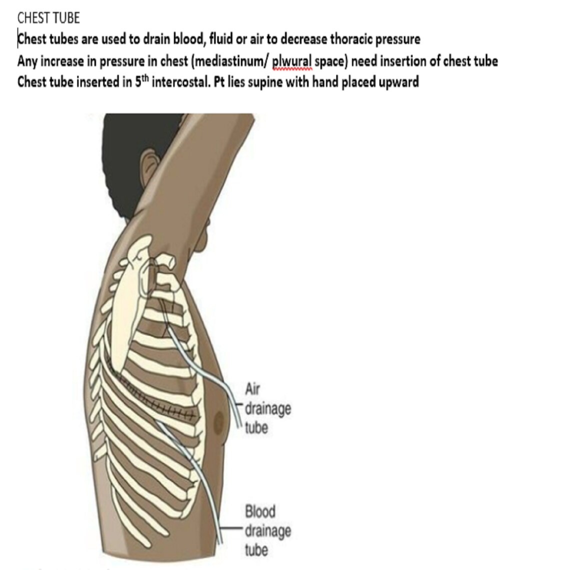 Chest Tube 5 Pages Study Guide of Everything You Need to Know for Your ...