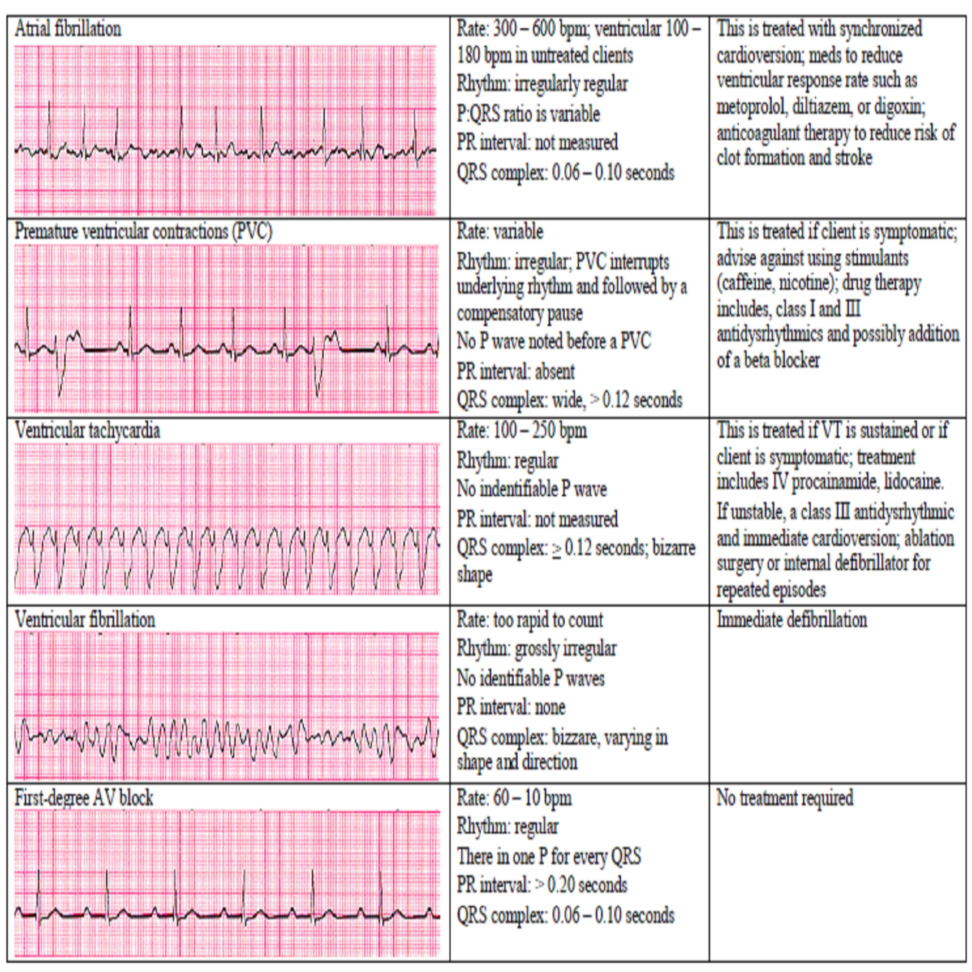 13 Cardiac Rhythm And Dysrhythmias Cheat Sheet Any Nurse Must Know For 13 Cardiac Rhythm And Dysrhythmias Cheat Sheet Any Nurse Must Know For
