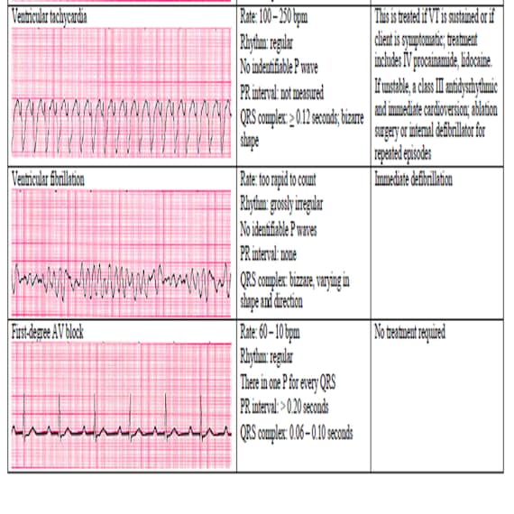 Heart Rhythm Flow Chart