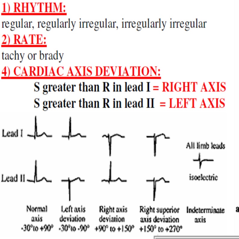 Any Nurse Must Know ECG Interpretation Cheat Sheet Made Easy - Etsy
