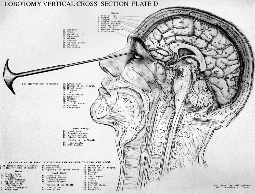 Lobotomy Orbitoclast & Hammer Surgical Medical Tools - Etsy UK