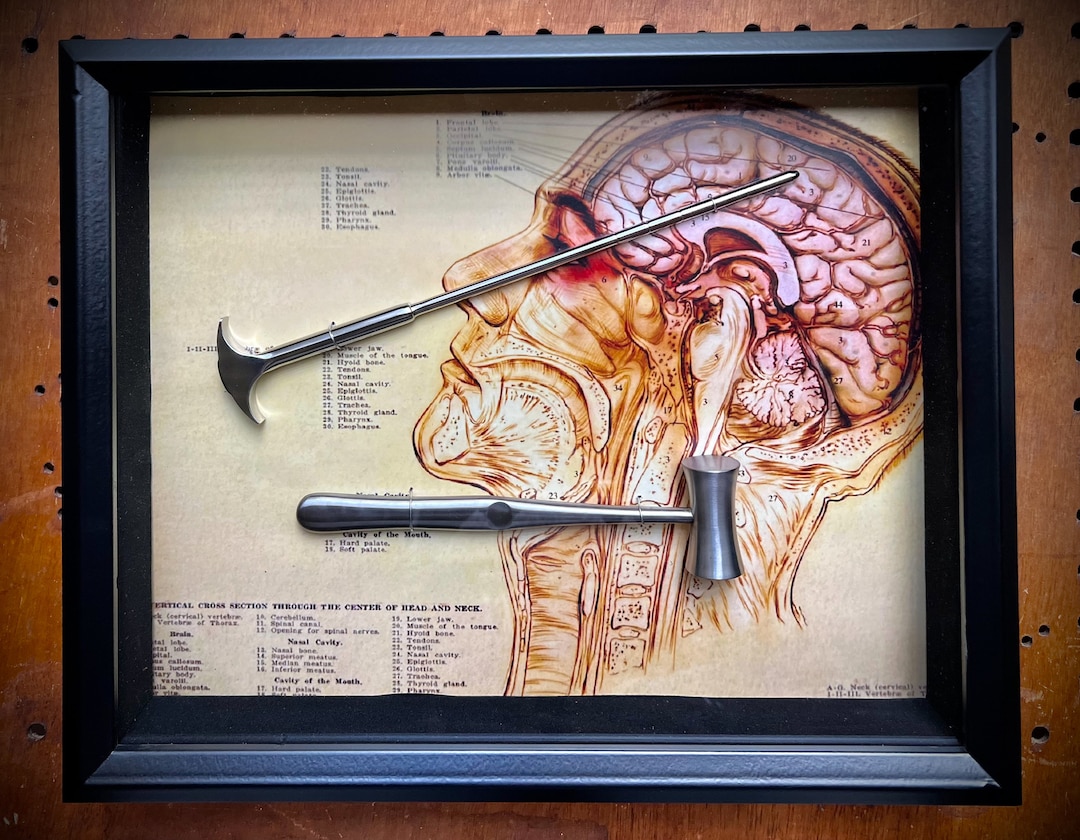 BESTSELLER! Lobotomy Shadowbox Display Large - Etsy